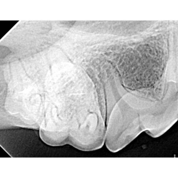 Dental X-ray positioning guide: Maxillary Molars 109 and 110 – D.A.V.I ...